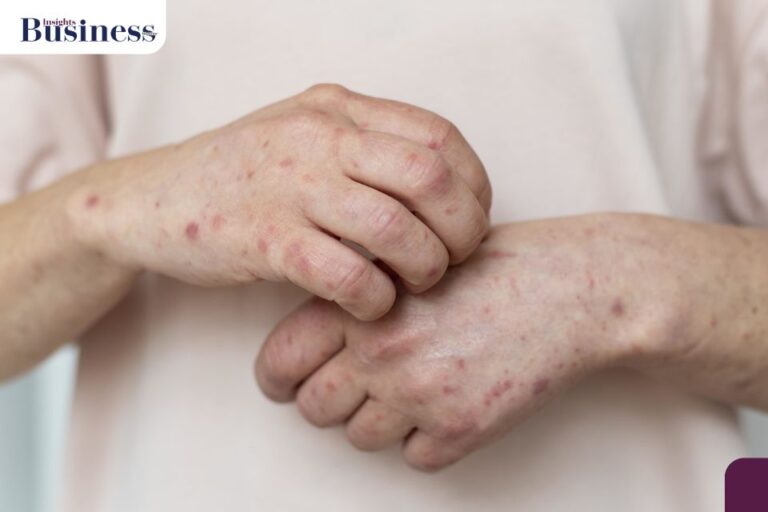 Actinic Keratosis: Early Signs of Skin Damage & Prevention