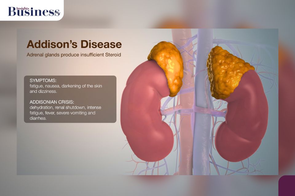 Addison’s Disease: Causes, Symptoms & Treatment Guide