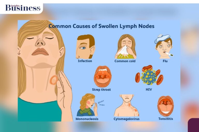 Adenitis - Understanding Inflammation in Lymph Nodes